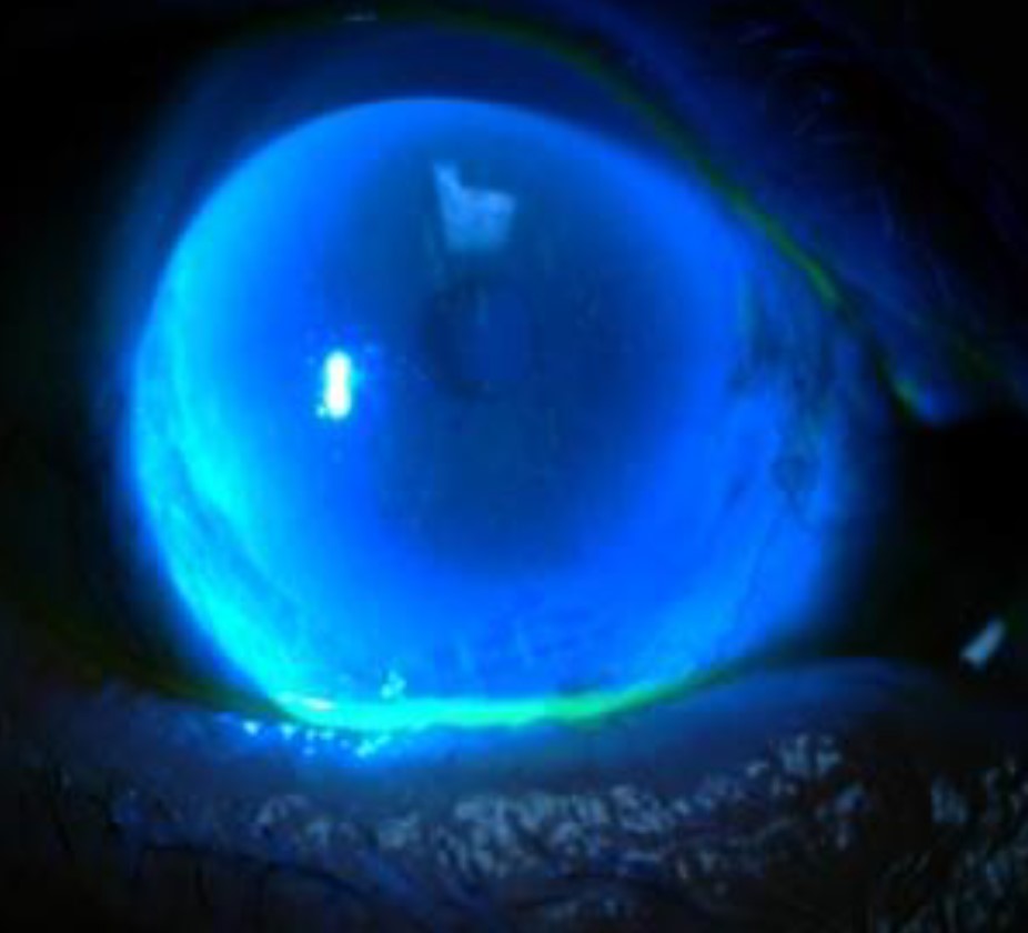 Ocular Surface Disease Index questionnaire in different languages ...